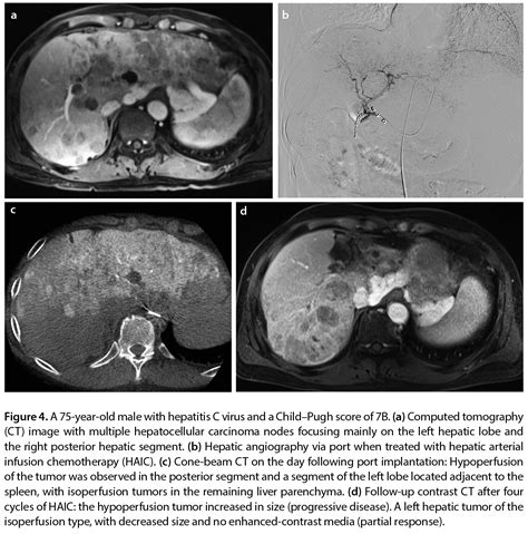 Usefulness Of Tumor Perfusion On Cone Beam Ct After Hepatic Arterial Infusion Port Implantation