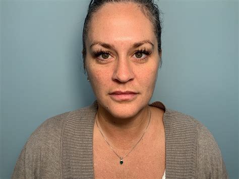 Before And After Prf Treatment In Murrieta Ca Lucali