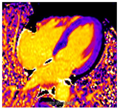 t1 mapping sequence shows a lower t1 time in the posterior