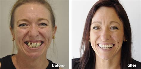 Teeths Before And After Dental News Network
