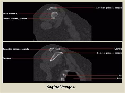 Presentation1 Pptx Radiological Anatomy Of The Shoulder Joint Pptx