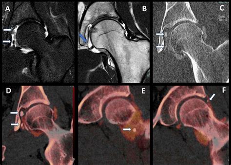 Capsular Labral And Loose Calcifications In Femoro Acetabular