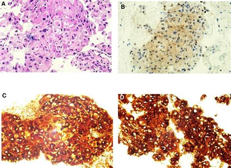 Histopathology Photo 4a Nested Architecture And Distinct Zellballen