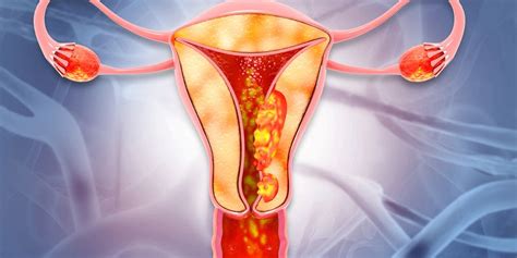 Endocrine Disruptors May Elevate Endometrial Cancer Risk Clinicallab