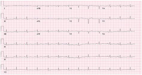 Ekg On Admission Showing Sinus Rhythm With First Degree Av Block And Download Scientific