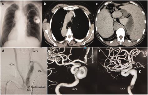 Pipeline Embolization Device Implantation In Large Carotid Cavernous Aneurysm Associated With