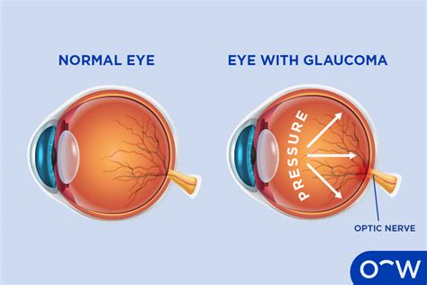 Glaucoma Definition Symptoms Types Causes Diagnosis And Treatments
