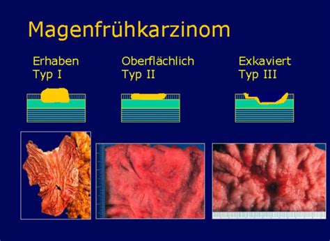 Magenkarzinom Doccheck Flexikon