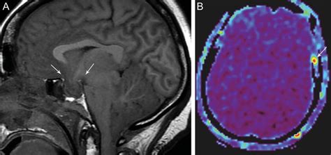Diffuse Cerebral Edema And Increased Intracranial Pressure Causing Download Scientific Diagram