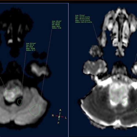 DWI Image And ADC Map Showing The CSF Lesion And Normal Appearing Download Scientific Diagram