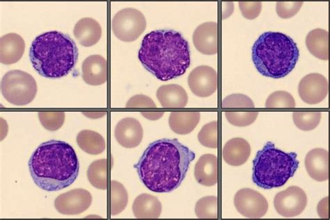 Patient Case 8 Mantle Cell Lymphoma Cellavision