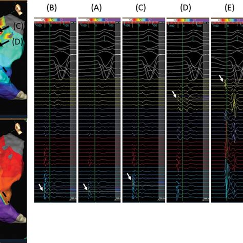 Biplane Fluoroscopy Image Right Anterior Oblique 30 Degrees Of The Download Scientific