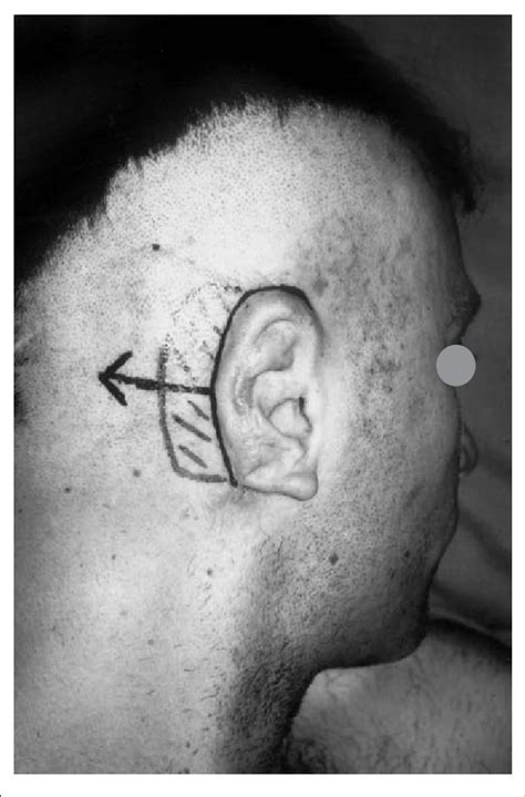 Third Surgical Step Skin Ways Using To Creation Of The Retroauricular