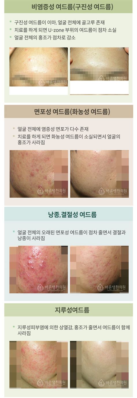 여드름 치료 프로그램