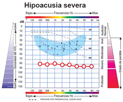Hipoacusia En Niños