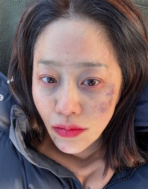 Ko Hyunjung With White Hair Bruises Whats Going On I Want To Sle Sportschosun