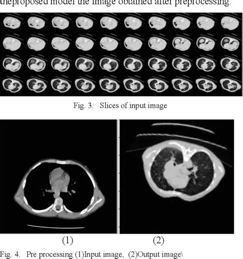 Figure 1 From Classification Of Lung Ct Scan Images Using Machine Learning Semantic Scholar