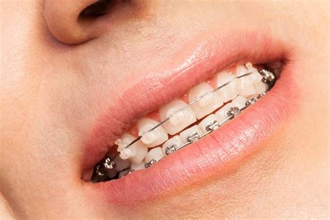 Are Clear Braces As Effective As Regular Braces