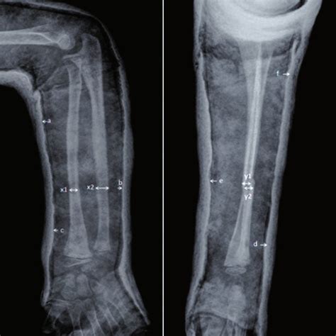 A Anteroposterior Ap Radiograph Showing Measurement Of Proximal Download Scientific