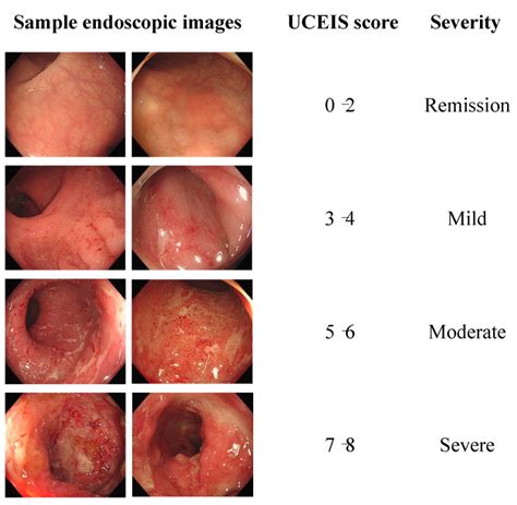 Using A Deep Learning Model To Address Interobserver Variability In The