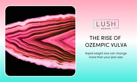The Rise Of Ozempic Vulva Causes Treatments And More — Lush Rx Med Spa