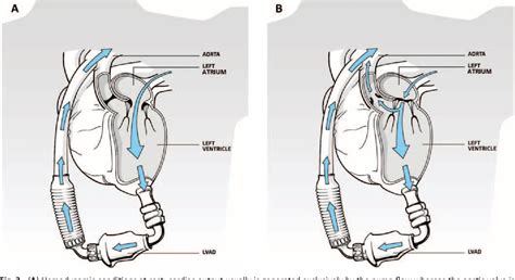 Figure 3 From Physical Capacity In Lvad Patients Hemodynamic