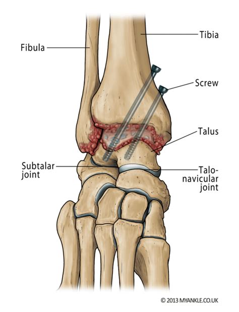Ankle Fusion — Ankle Arthritis Ankle Replacement Arthrodesis Ankle Fusion