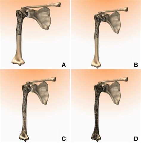 Types Of Humeral Resection A Type I—intraarticular Proximal Humerus Download Scientific