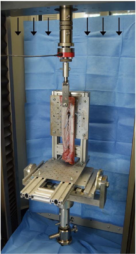 Figure 1 From Suture Button Reconstruction Of The Central Band Of The Interosseous Membrane In