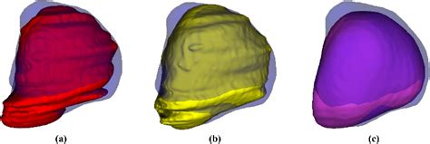 3d Visualization Of The Segmentation Results In A Trus Volume