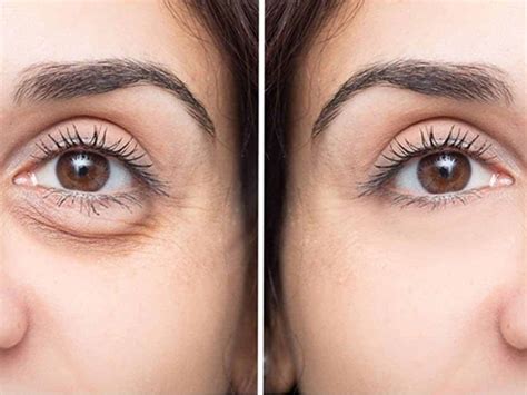 سیاهی دور چشم به چه دلیل ایجاد می‌شود؟ راه‌های درمان و پیشگیری شاپ پلاس