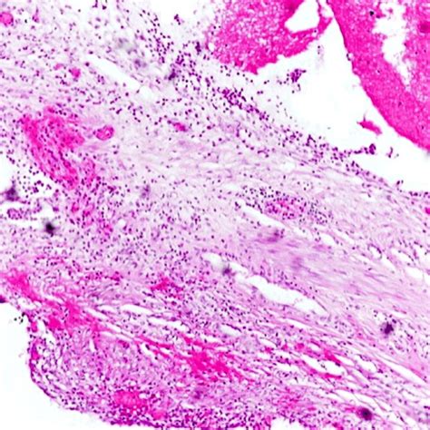 Duplication Cyst Resected Il Ileal Side Of The Common Wall Iw