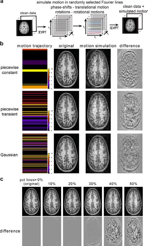 Figure 2 From Retrospective Motion Artifact Correction Of Structural Mri Images Using Deep
