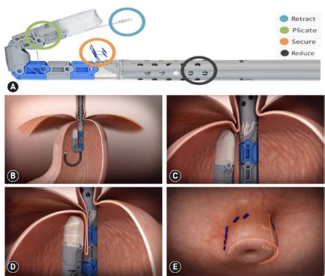 Role Of Endoscopy In Gastroesophageal Reflux Disease Pmc