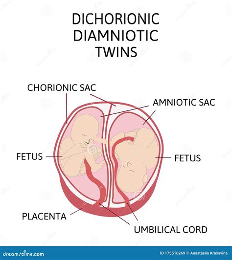 Twin Types Monozygotic Or Dizygotic Placentation Of Twins Monochorionic Vector Illustration