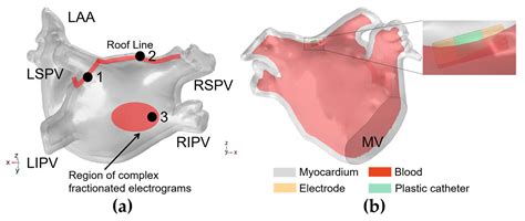 Effect Of Anisotropic Electrical Conductivity Induced By Fiber Orientation On Ablation