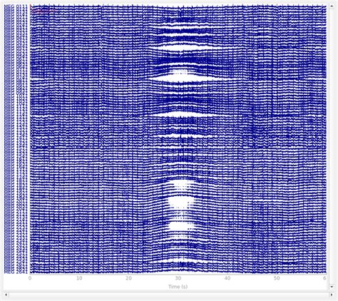 Overview Of Artifact Detection — Mne 1 1 1 Documentation