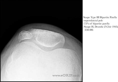 Bipartite Patella Q EORIF