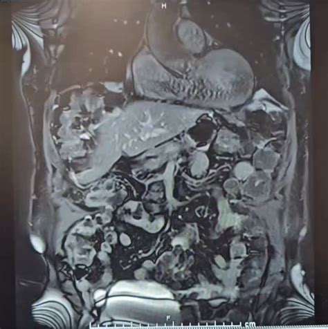 [video] Faisal Nawaz On Linkedin Endoscopic Retrograde Cholangio Pancreatography Ercp In A