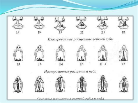 Расщелина верхней губы и нёба презентация онлайн