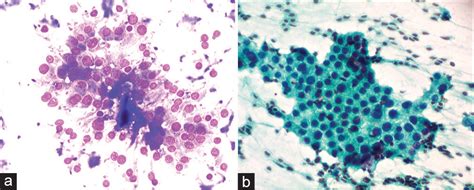 Unusual Case Of Parietal Scalp Swelling Without Palpable Swelling In