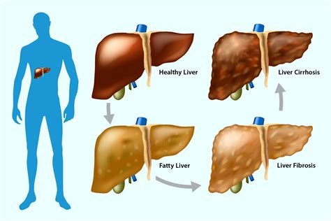 Fatty Liver To Cirrhosis Timeline