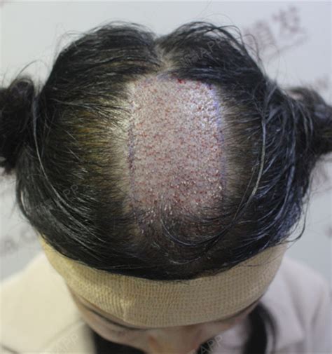 加密植发榜首新生为什么明星秃头不植发 随意云