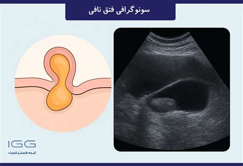 سونوگرافی فتق نافی تشخیص فتق ناف در جنین، کودک و بزرگسال