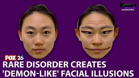 Long Face Syndrome Symptoms Myofunctional Disorders — Kenmore Myo