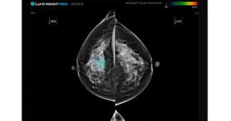 [게시판] 루닛 강북삼성병원에 Ai 유방암 검진 설루션 공급