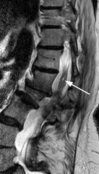 Ventriculus Terminalis Radsource