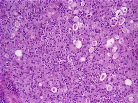 Pathology Outlines Secretory