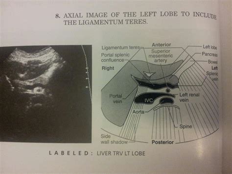 Ligamentum Teres Ultrasound