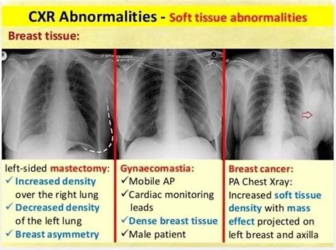Chest X Ray Abnormalities Neha Thakur